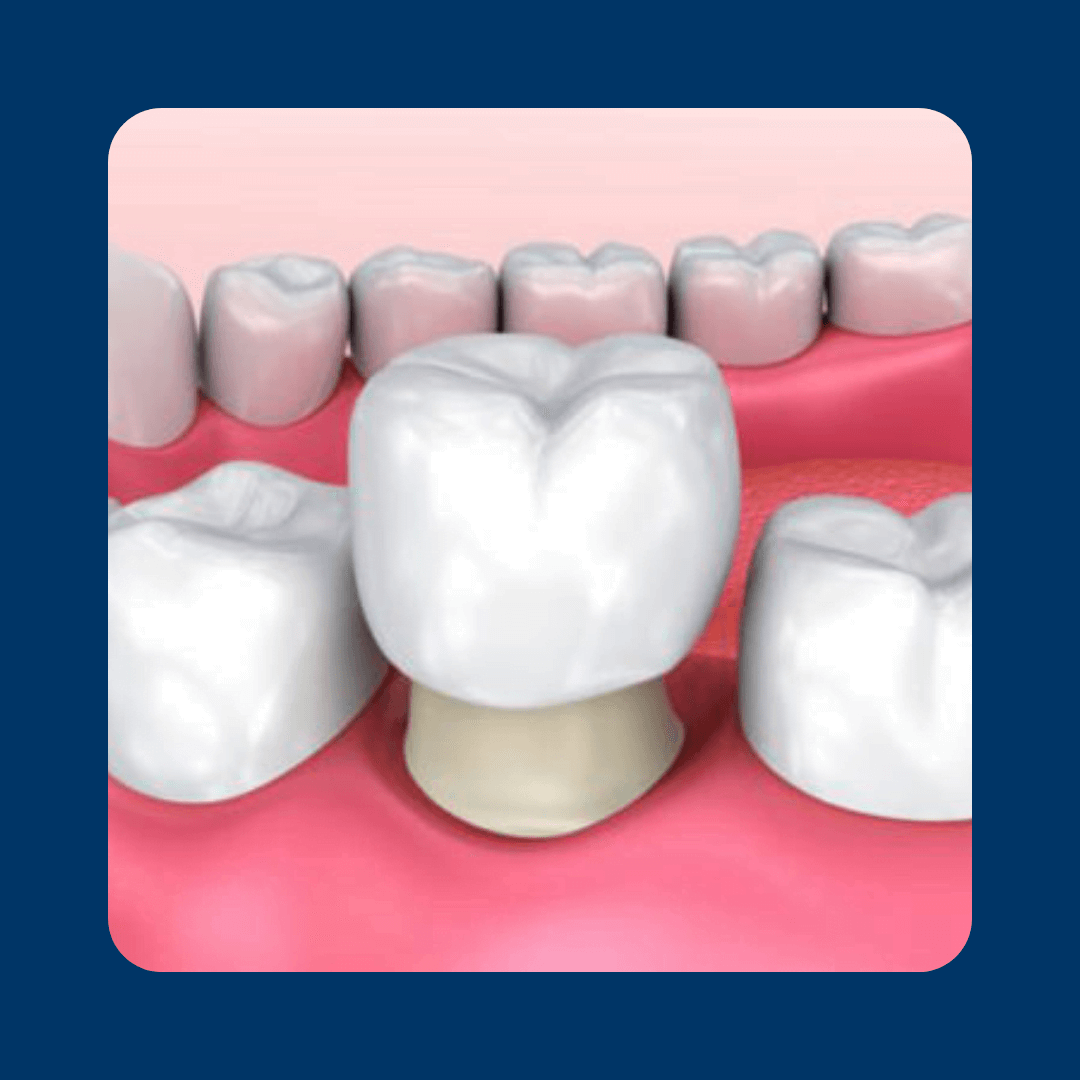 Dental Crown & Bridge Treatment For Beautiful Teeth - Dental Home