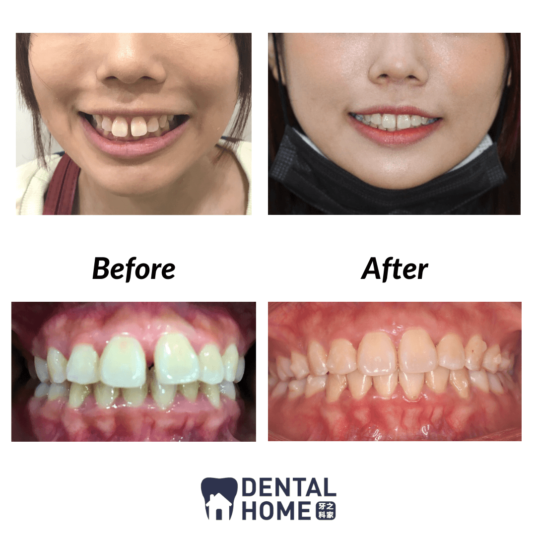 Smile Assessment for Invisalign Treatment in Malaysia | Dental Home