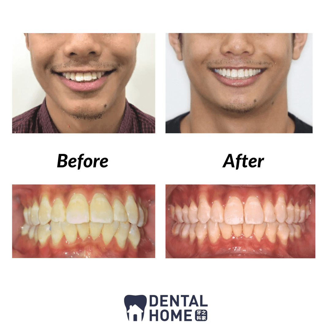 Smile Assessment for Invisalign Treatment in Malaysia | Dental Home